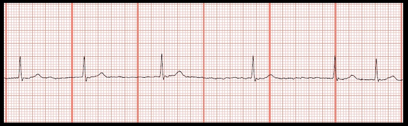 EKG Rhythm Strip Quiz 131