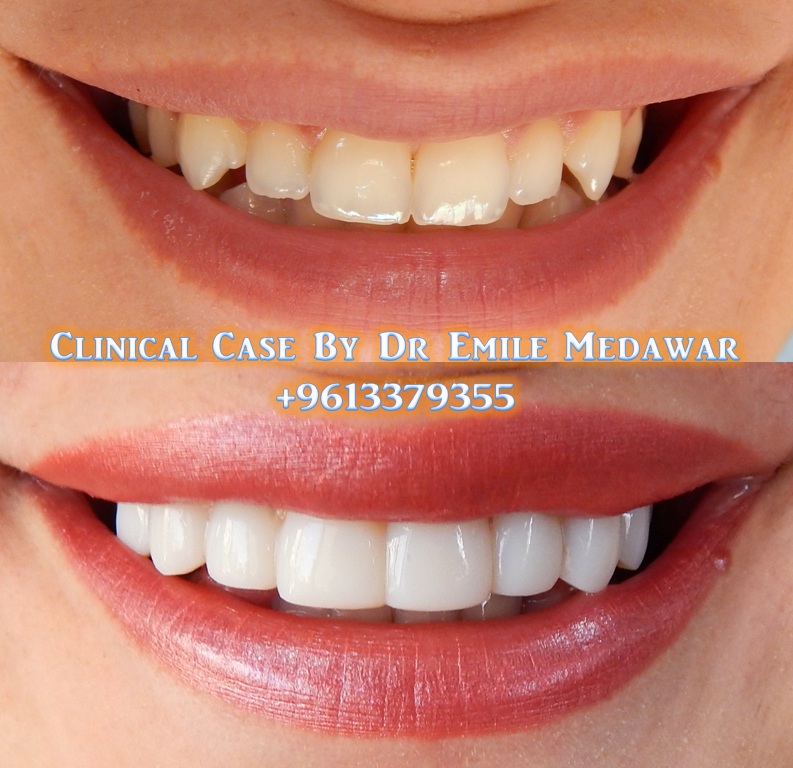 Hollywood Smile Lebanon, Beirut Dentist Dr Emile Medawar: hollywood ...