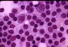 Pathology: Lymphoplasmacytic lymphoma