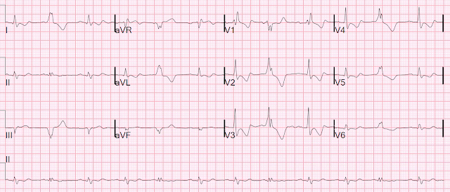 Dr. Smith's ECG Blog: Right Bundle Branch Block and ST Depression in V1 ...