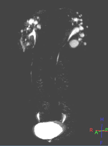 Acquired cystic kidney disease - Sumer's Radiology Blog