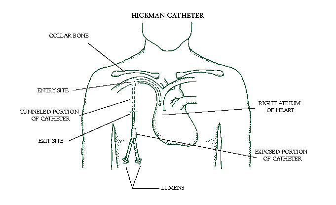 Making Memories Of Us: The Hickman Catheter