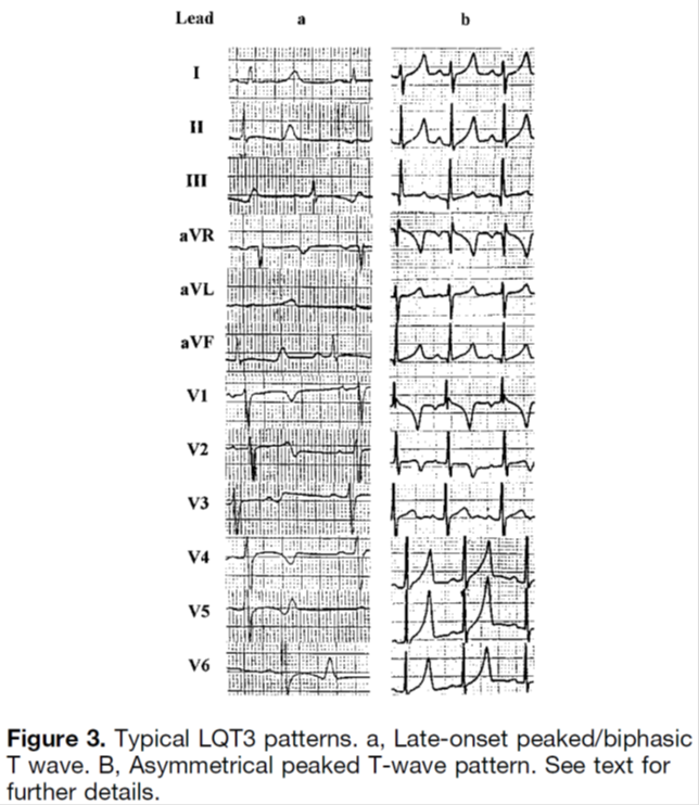 Pedi cardiology: LQTS - Type Recognition by T wave Morphology