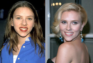 Rhinoplastik: Was ist rhinoplastik