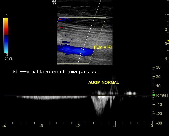 Deep-vein thrombosis- before and after treatment: ~ Ultrasound Cases Info