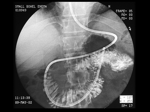 Hello USA: enteroclysis