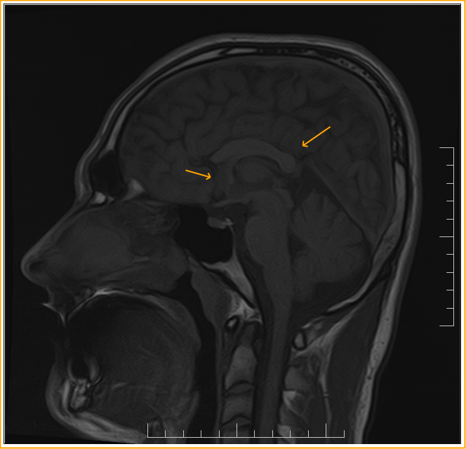 Agenesis of Anterior Corpus Callosum-Rare Finding - Sumer's Radiology Blog