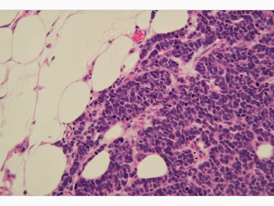 Dermpath Made Simple - Neoplastic: Merkel Cell Carcinoma