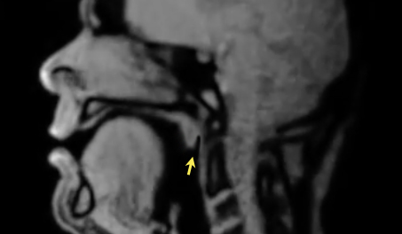 Velopharyngeal Insufficiency (VPI) After UPPP or Uvula Excision Surgery ...