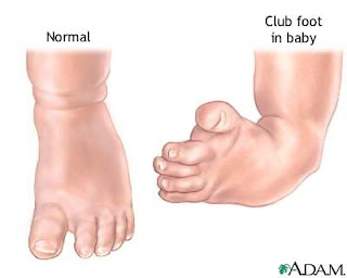 Home: kenali clubfoot atau ctev (kaki pengkor) pada anak