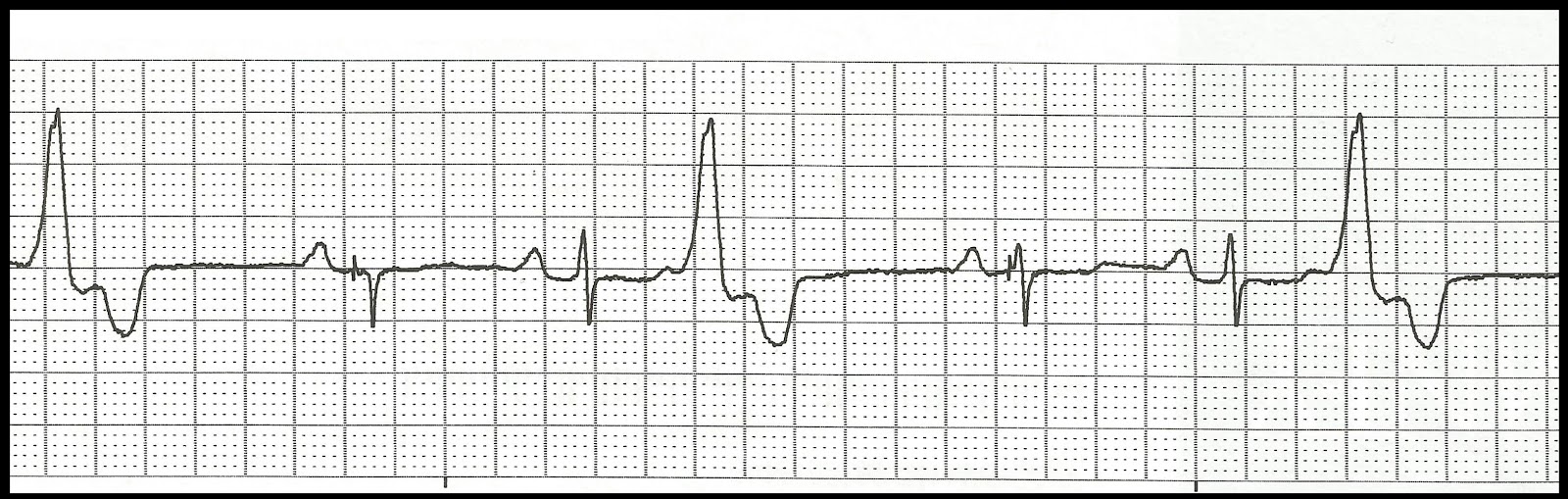 EKG Rhythm Strip Quiz 117