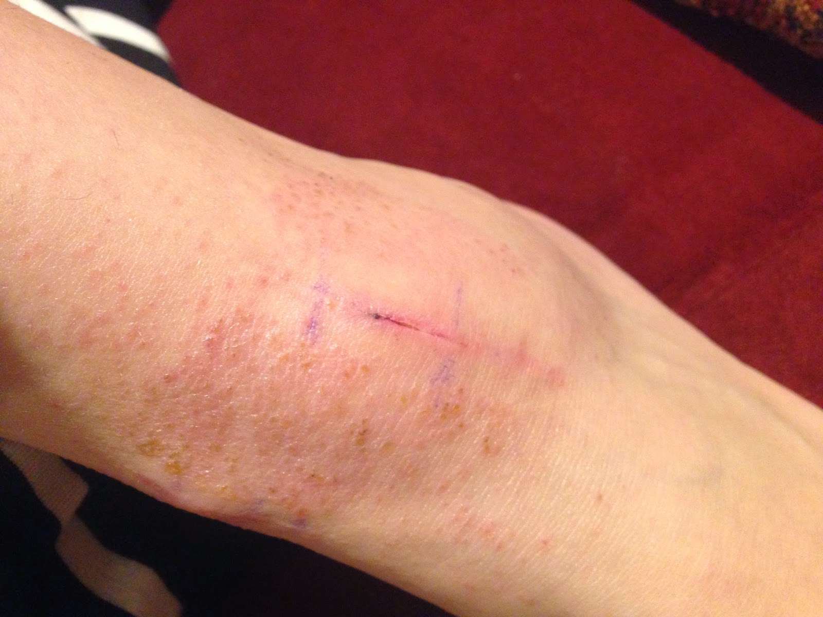 No More Lyme-ing Now I Mean It!: Kayla's Bartonella Diagnosis and Treatment