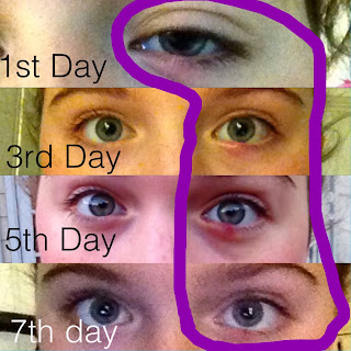 odds and ends: Stye: what is it.. how can I remove it?!?