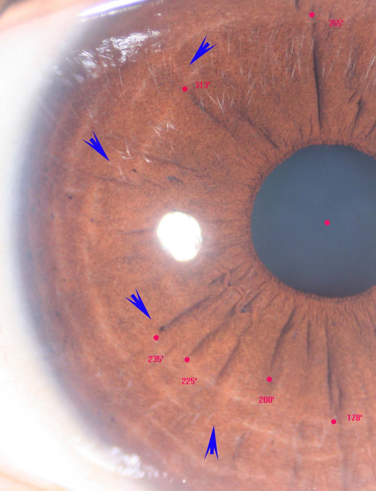 Modern & Multidimensional Iridology: Intersaction of Radial ...
