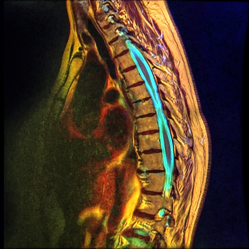 Nevit's blog: Dorsal Spine Color MRI