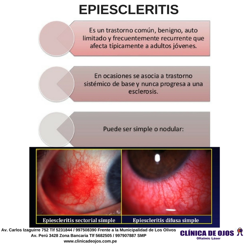 Clínica de Ojos Oftalmic Láser: EPIESCLERITIS