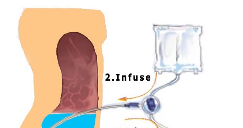 CAPD: Mekanisme CAPD