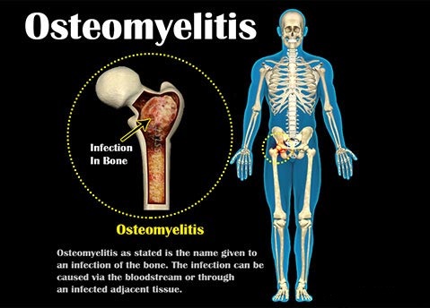 Prepare for Medical Exams : Osteomyelitis - Case Discussion And Questions