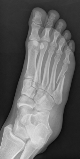 Un médecin du sport vous informe: Fractures des métatarsiens, des ...