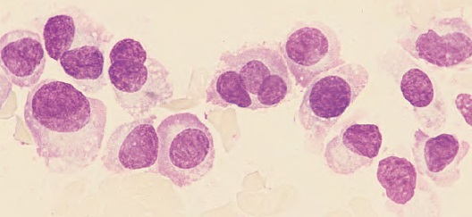 Doença de Crohn: novas perspectivas: Neoplasias de plasmócitos