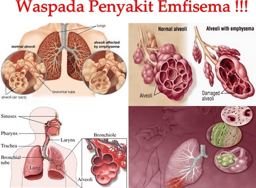 Macam macam penyakit yang disebabkan oleh paru paru : Sehat Itu Penting