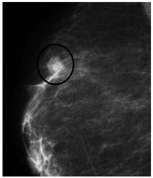 patologiab2013: Caso clínico: Nódulo en glándula mamaria