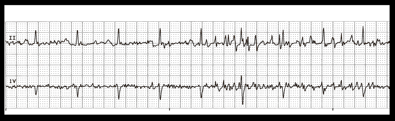 EKG Rhythm Quiz 229
