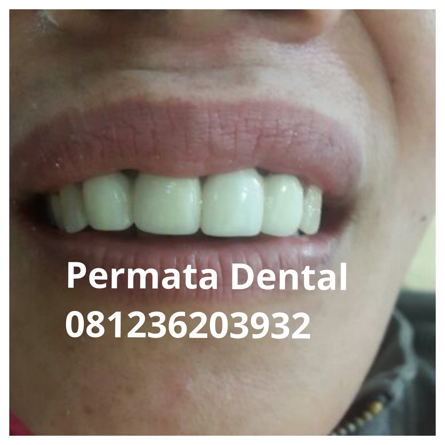 DOKTER GIGI BALI PERMATA DENTAL : Merapikan Gigi Renggang Dengan Bridge ...