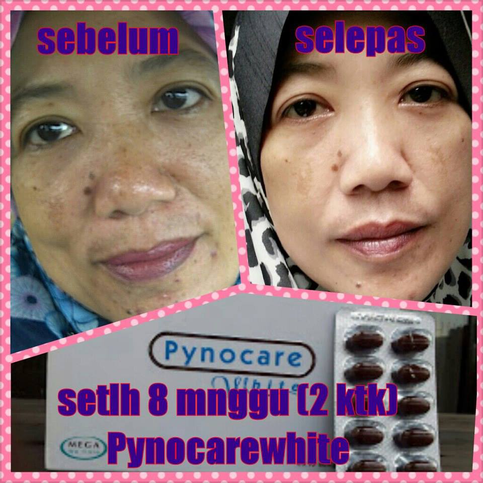 RUBY PYNOCARE WHITE: APA ITU MELASMA
