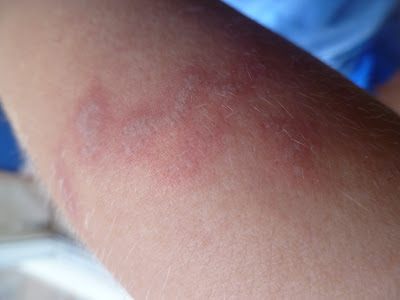 VINGEAR TO TREAT JELLY FISH WOUNDS! ANOTHER GREAT USE FOR VINEGAR ...