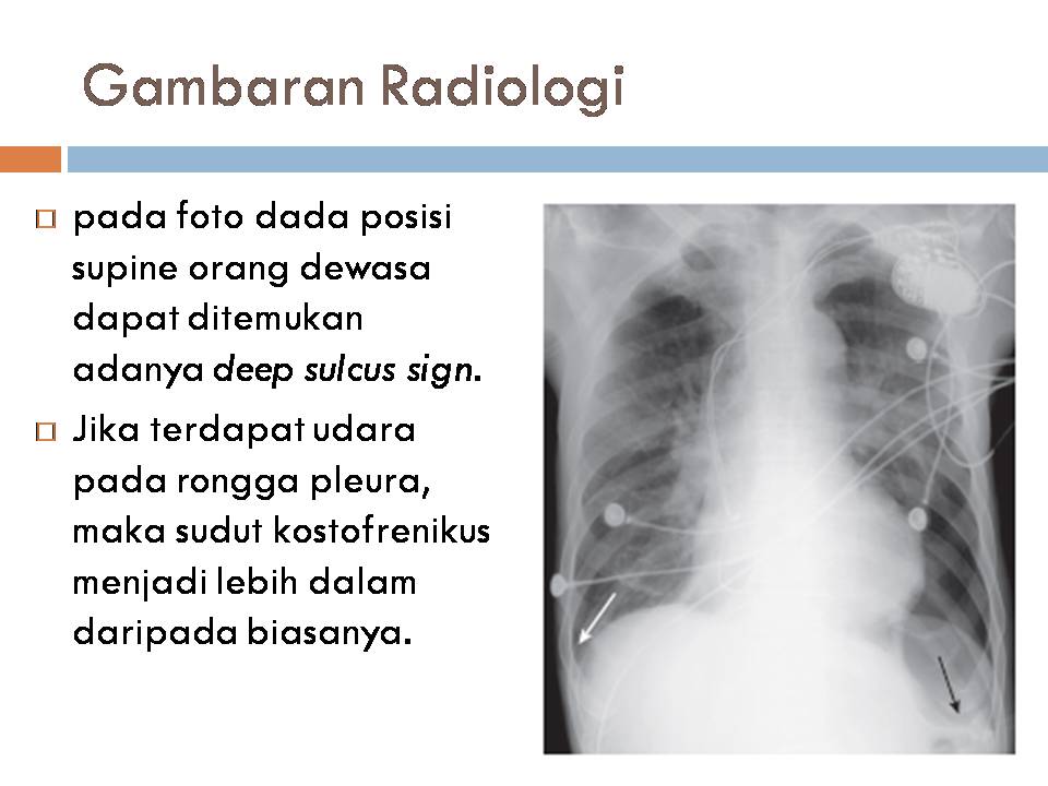 Gambaran Radiologis Pneumotoraks