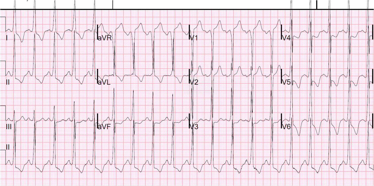 Dr. Smith's ECG Blog: History of Hypertrophic Cardiomyopathy (HOCM ...