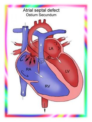 Atrial septal defect - Sure Developers Team