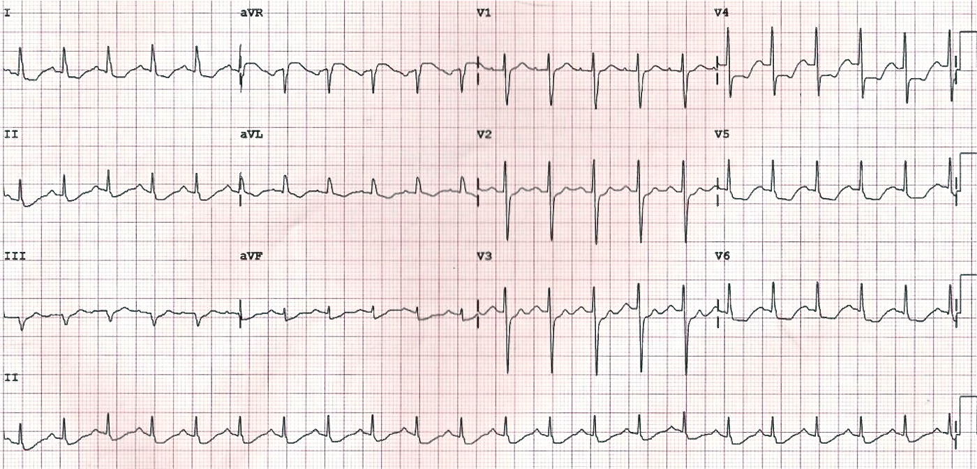 Iskemia Miokardium | INA - ECG