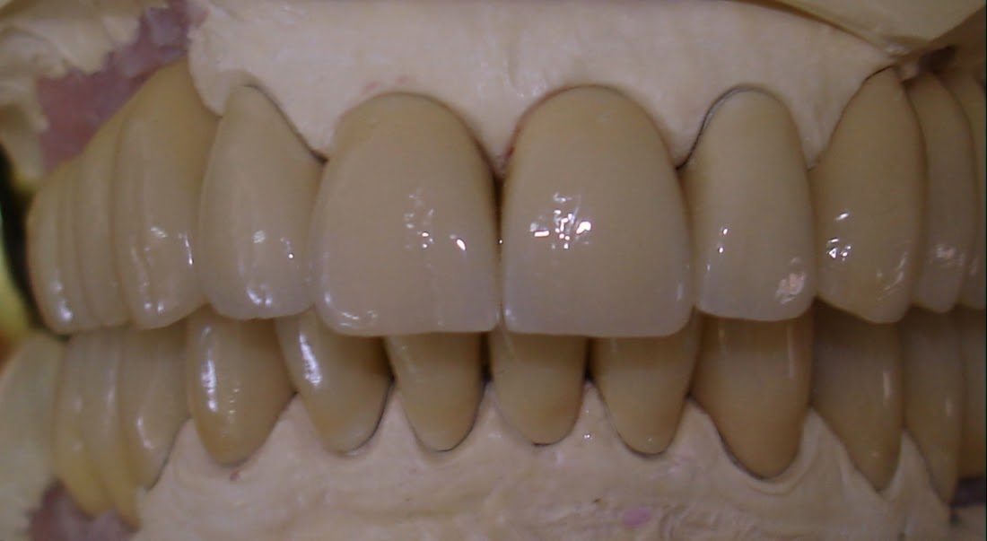 Prótese Dentária Figueiredo: Cerômeros