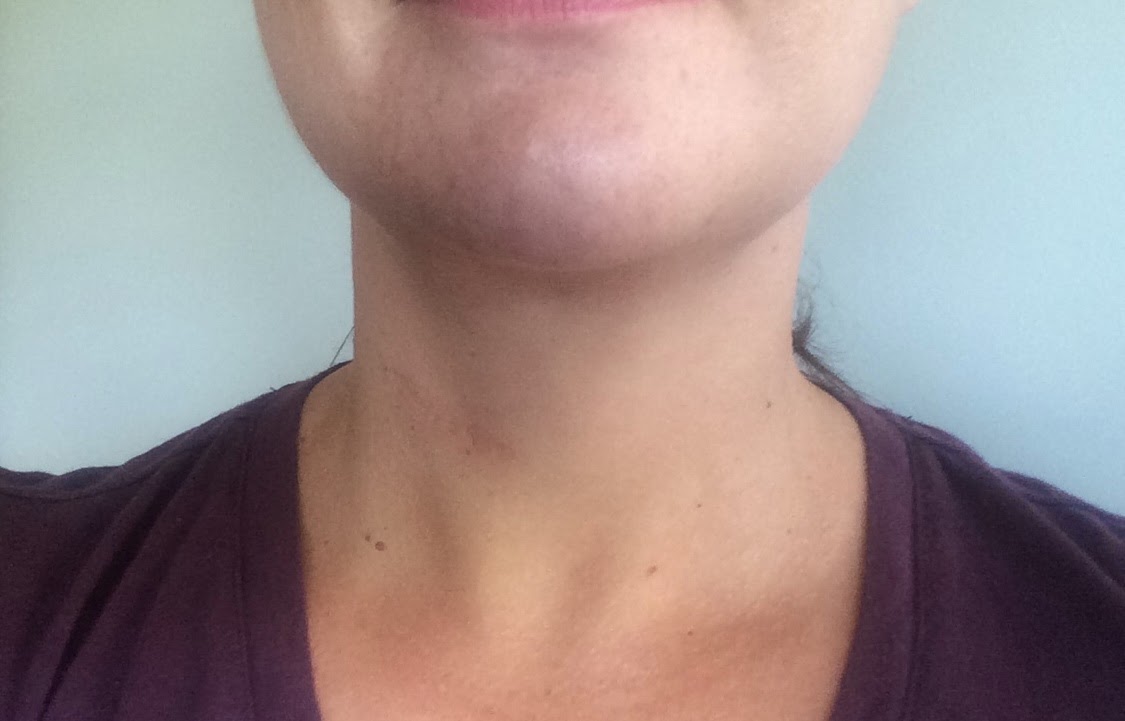 The Scar: Photo Retrospective | ACDF: Neck is Wack