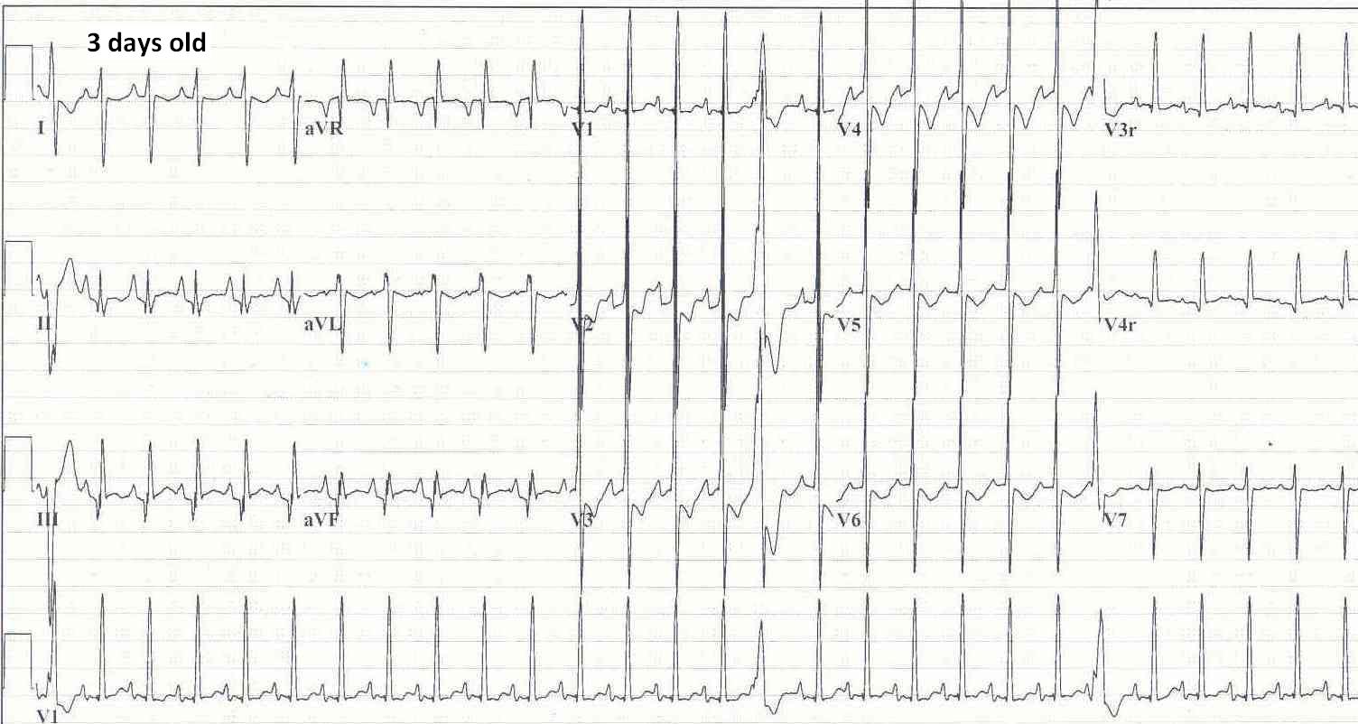 PediCardiology Quiz Answers: Quiz #15: 12-lead EKG - Inverted P in Lead I