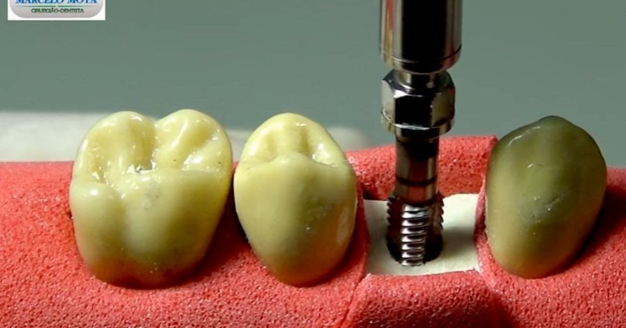 IMPLANTE DENTÁRIO - passo a passo - Odonto-Tv