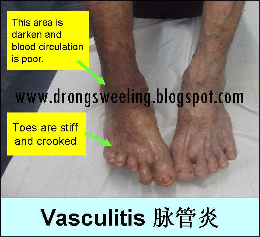 TCM News: TCM Clinic Physician treat Vasculitis on Lower Legs