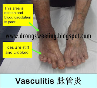 TCM News: TCM Clinic Physician treat Vasculitis on Lower Legs
