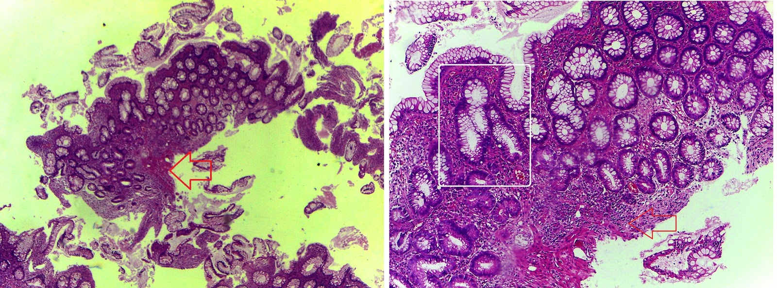GASTROINTESTINAL AND LIVER HISTOLOGY PATHOLOGY ATLAS: COLON: ULCERATIVE ...