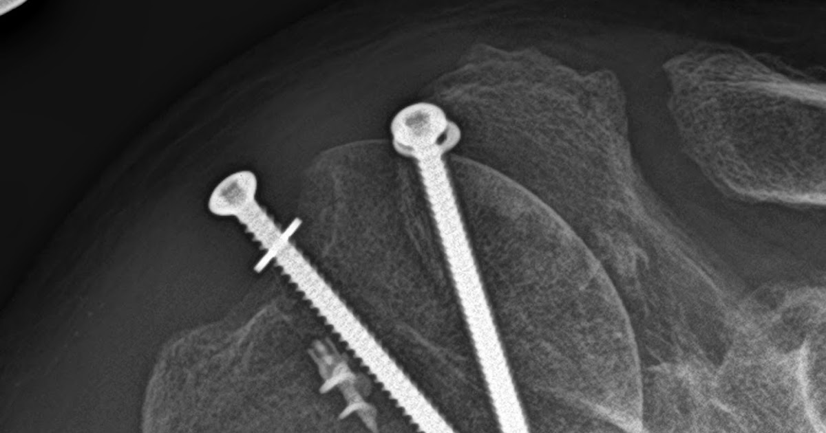 UW Shoulder and Elbow Academy: Reverse total shoulder joint replacement ...