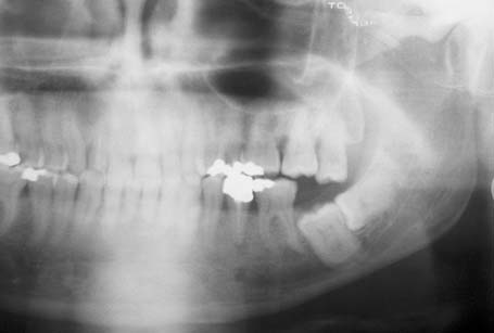Dentistry and Medicine: Impacted Mandibular 3rd Molar Classification ...