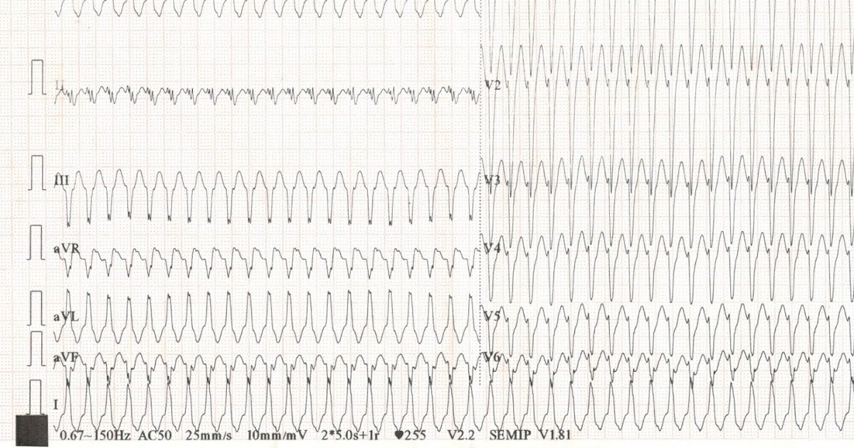Cardiology window: Mahaim fiber tachycardia