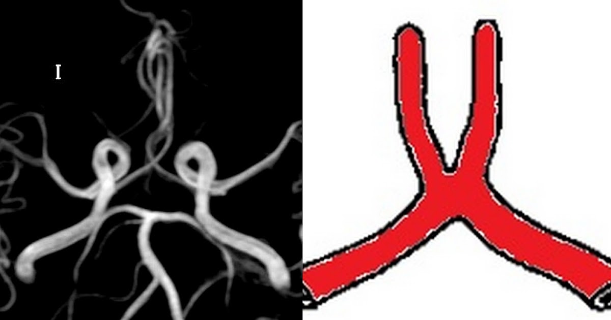 Dr Balaji Anvekar FRCR: Absent Acom