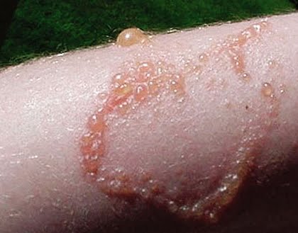 Philosophy of Science Portal: Pretty poison..."poison ivy"