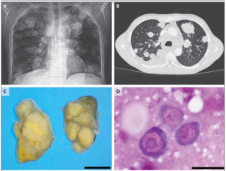 Parasitic cancer in human host