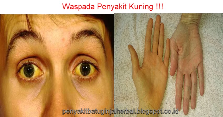 Cara Mengobati Penyakit Kuning | AHLINYA PENGOBATAN GINJAL