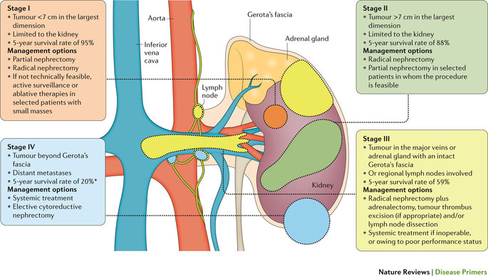 Renal/ Kidney cancer | notes.nursium.com