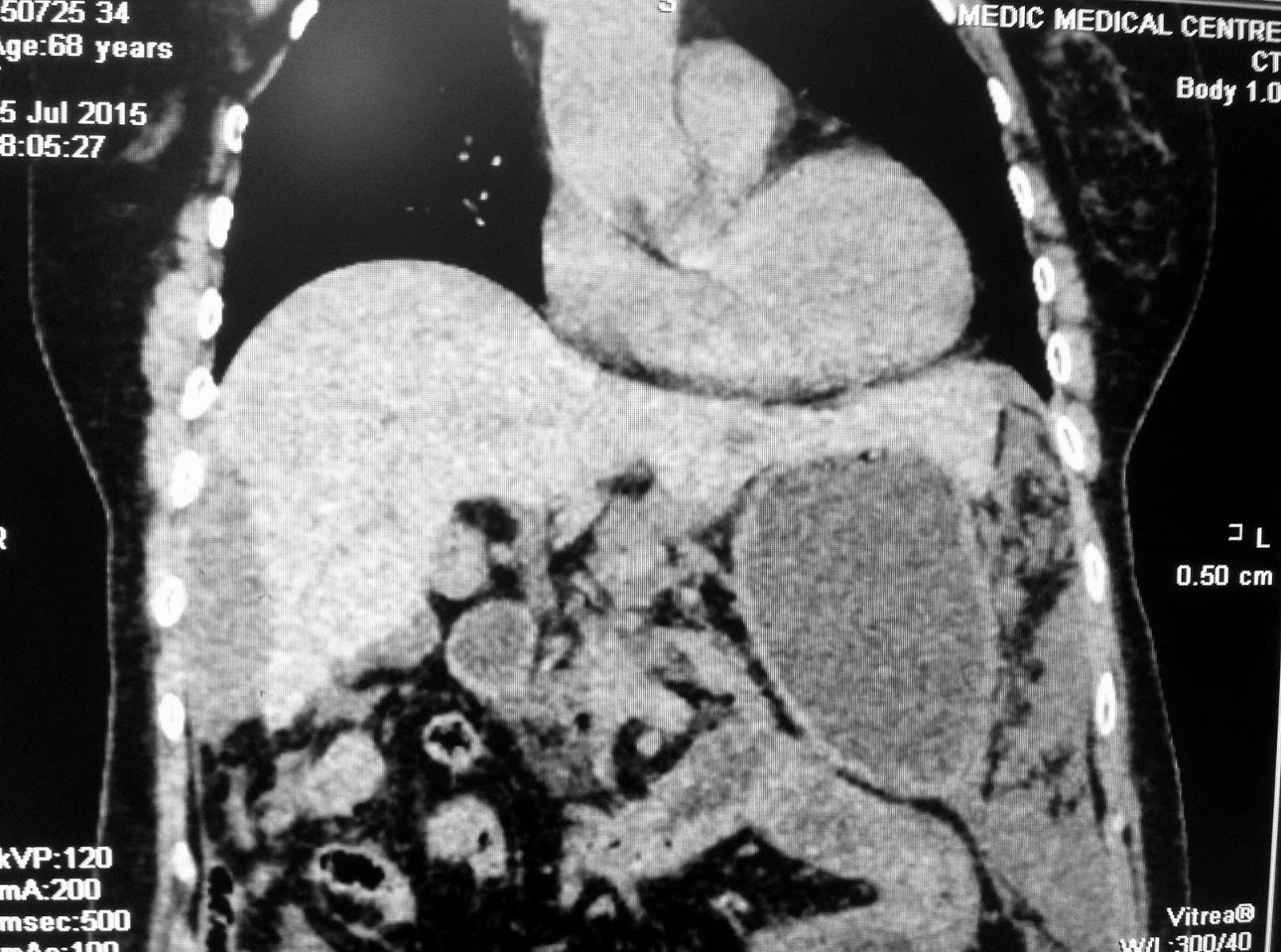 VIETNAMESE MEDIC ULTRASOUND: CASE 332 : PERITONEAL CARCINOMATOSIS, Dr ...